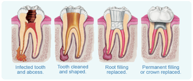 How Much Does a Root Canal Cost? NHS vs Private | The Vallance Dental ...
