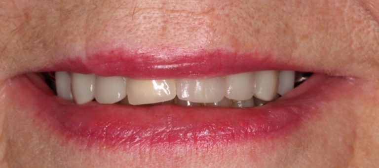 Types of Dentures: A Comprehensive Guide | The Vallance Dental Centre