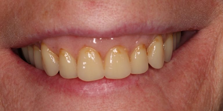 Immediate Dentures Manchester | The Vallance Dental Centre