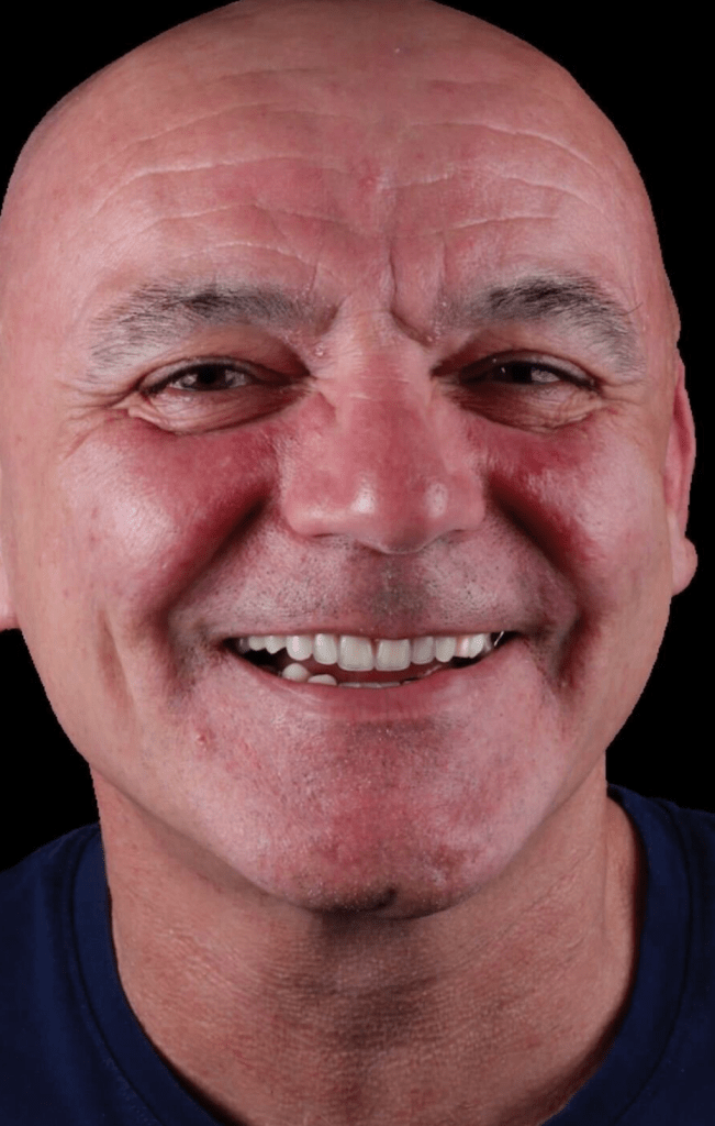 Bespoke Dentures Manchester | The Vallance Dental Centre