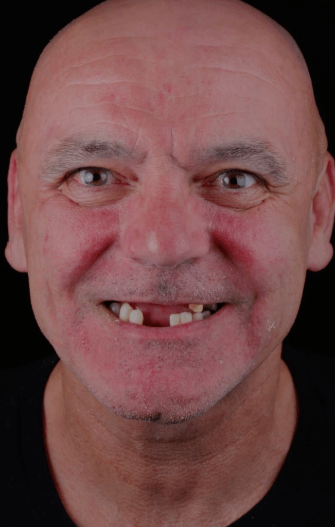 Bespoke Dentures Manchester | The Vallance Dental Centre