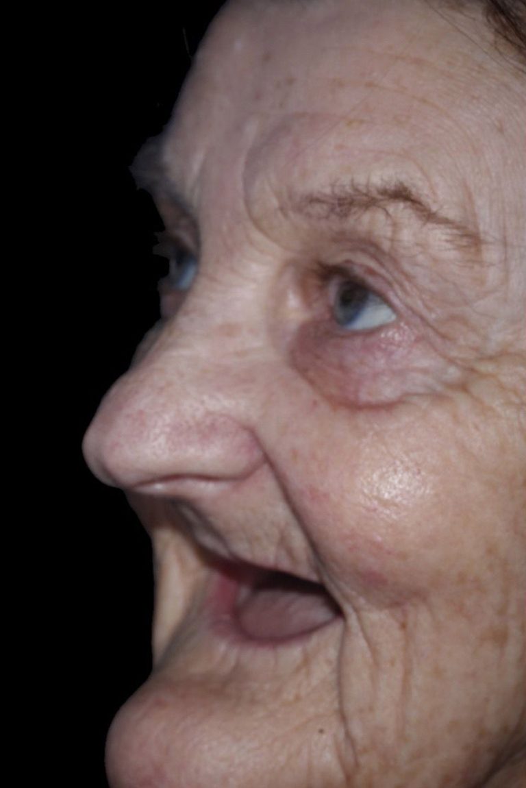 Types of Dentures: A Comprehensive Guide | The Vallance Dental Centre