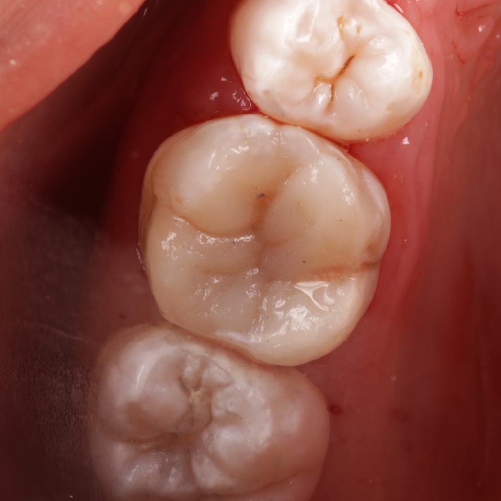 Cosmetic fillings in Manchester | The Vallance Dental Centre